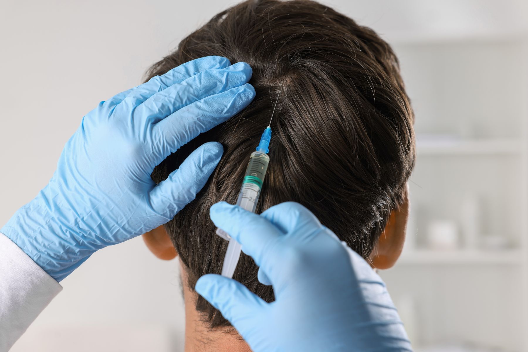 Scalp Microneedling for Hair Loss in Tampa Bay